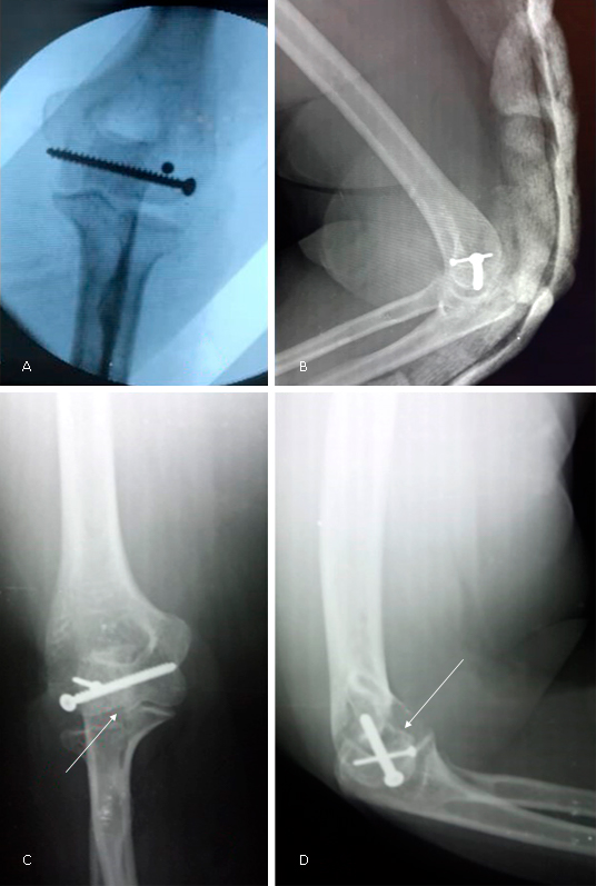 Fractura de capitellum en el adulto
