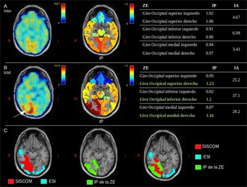 Cuantificación de la perfusión cerebral por SPECT utilizando co-registro con IRM y atlas anatómicos